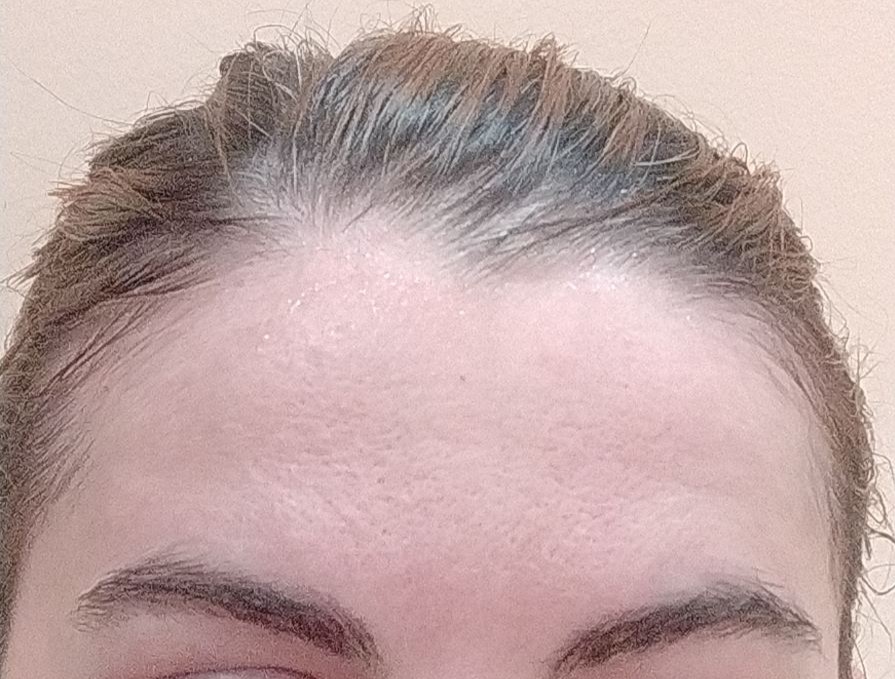 Τα ακάρεα demodex μπορεί να προκαλέσουν τριχόπτωση; | DOCTORS FAMILY ...